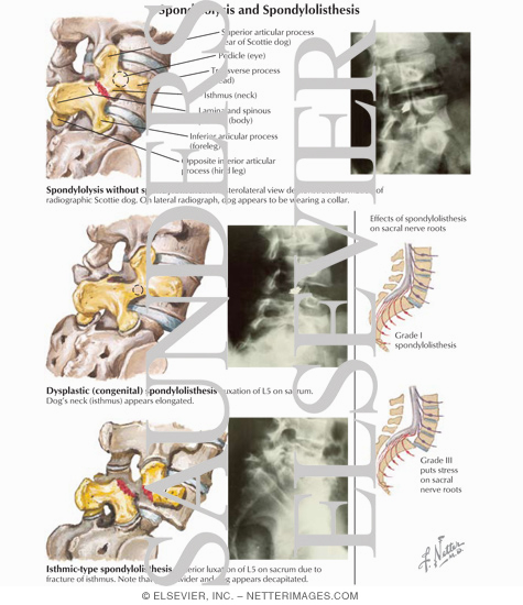 Spondylolysis and Spondylolisthesis