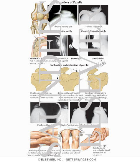 Disorders of Patella
