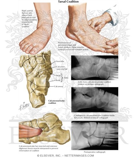 Tarsal Coalition Pediatric Disorders of the Foot and Ankle