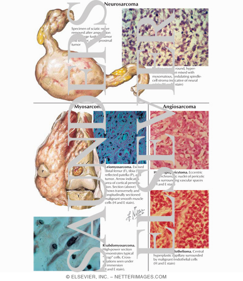 Neurosarcoma, Myosarcoma, Angiosarcoma