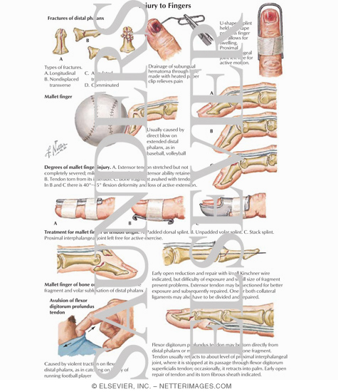 Injury to Fingers