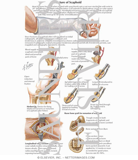 Fracture of Scaphoid: Blood Supply and Treatment