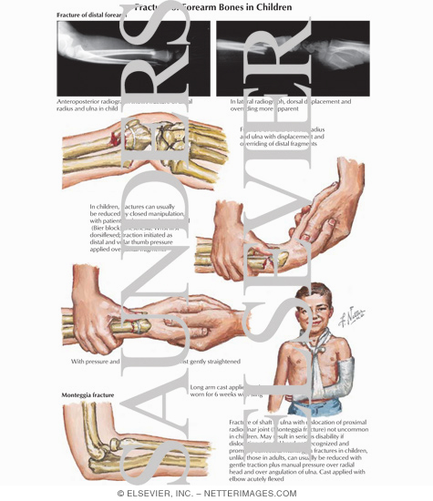Fracture of Forearm Bones in Children