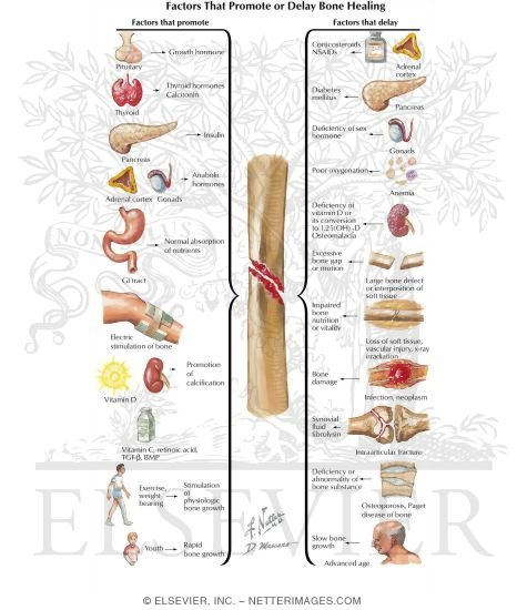 Factors That Promote or Delay Bone Healing