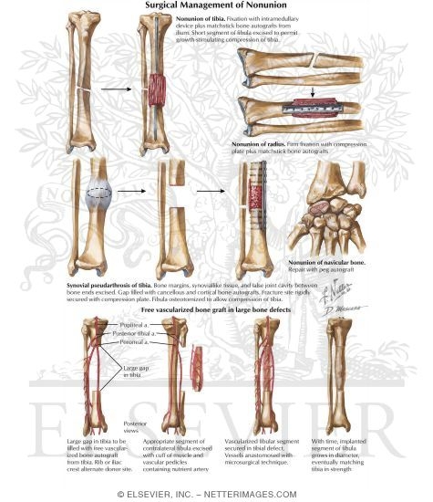 Surgical Management of Nonunion