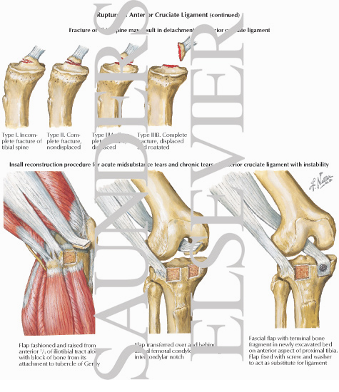 Rupture of Anterior Cruciate Ligament