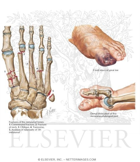 Fractures of Metatarsals, Crush Injury, and Dislocation of Great toe