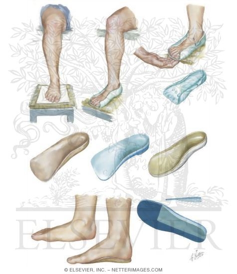 Technique of Fitting Prescription Orthotic Device: Some Types of ...