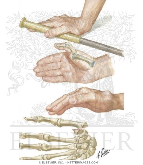 Fractures and Dislocations of Thumb