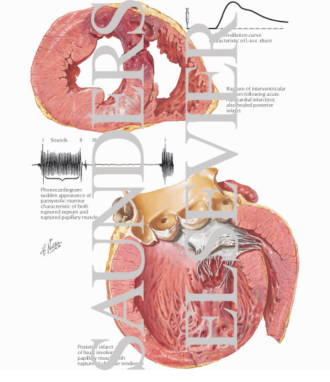 Arteriosclerotic Heart Disease