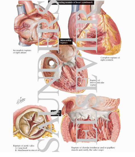Nonpenetrating Heart Wounds