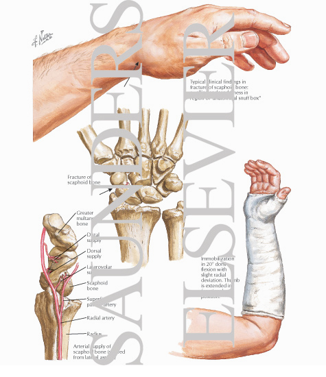 Fracture of the Scaphoid (Navicular)