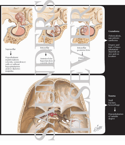 Nontumorous Lesions of the Pituitary Gland