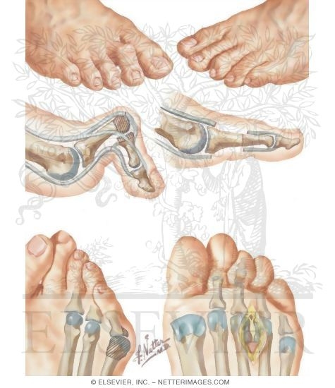 Hammer Toe, Bunionette, Morton's Toe