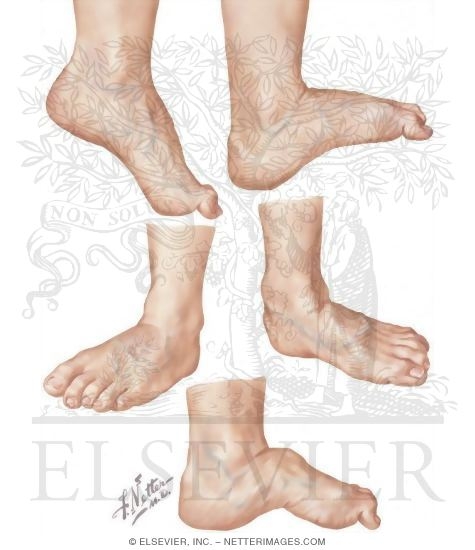 Foot Deformities