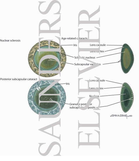 Types of Senescent; Senile Cataracts