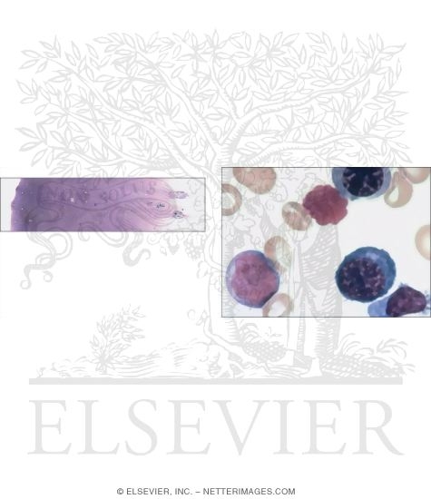 Light Micrograph of a Bone Marrow Smear at Low (Above) and High (Right ...