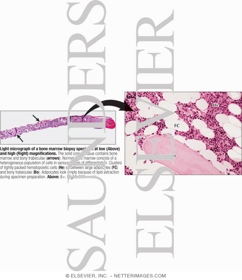 Light Micrograph of a Bone Marrow Biopsy Specimen at Low (Above) and ...