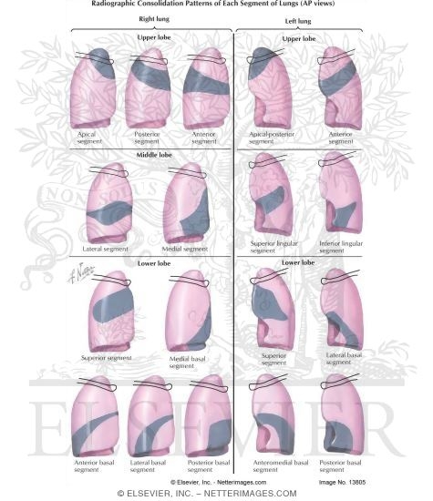 Radiographic Consolidation Patterns of Each Segment of Lungs (AP views)
