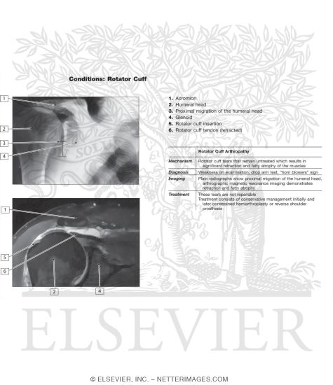 Conditions of the Rotator Cuff