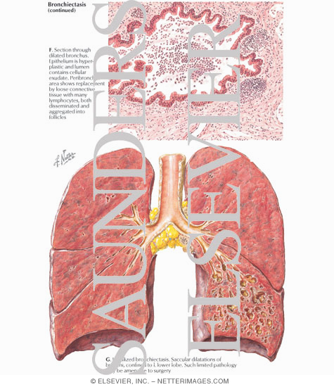 Bronchiectasis