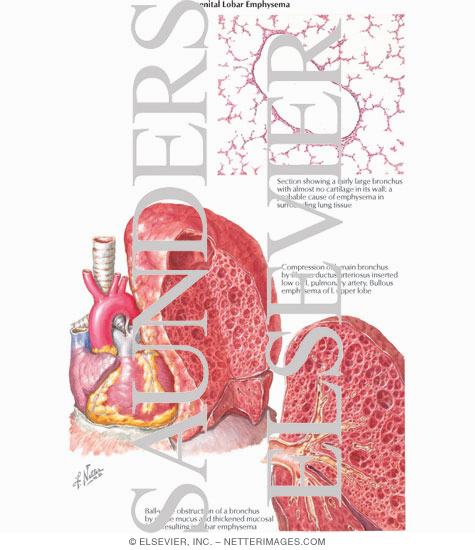 Congenital Lobar Emphysema