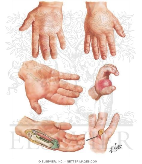 Deep Space Infections