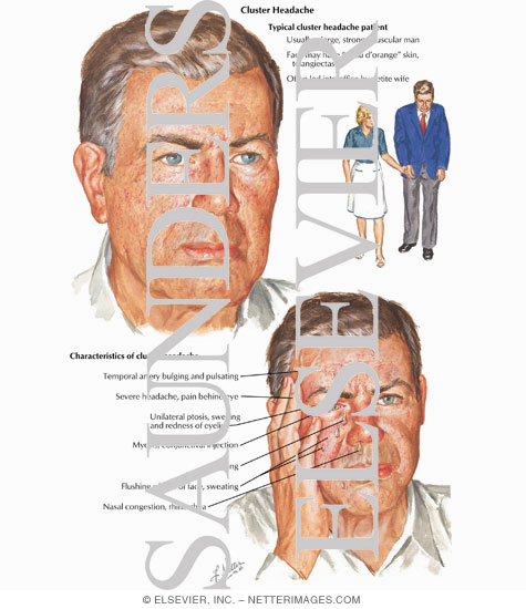 Cluster Headache