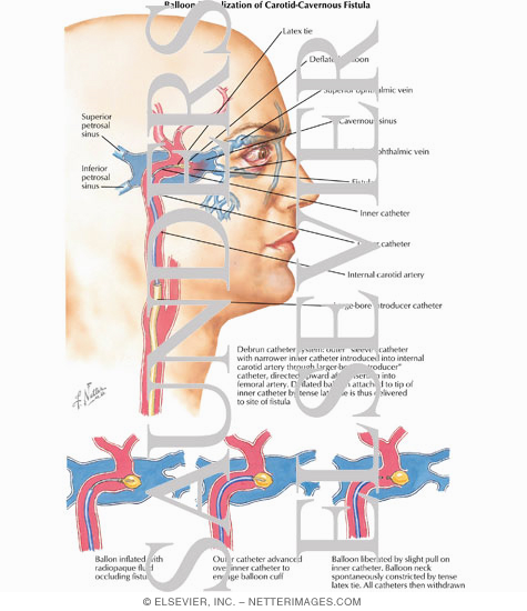 carotid cavernous fistula - meddic