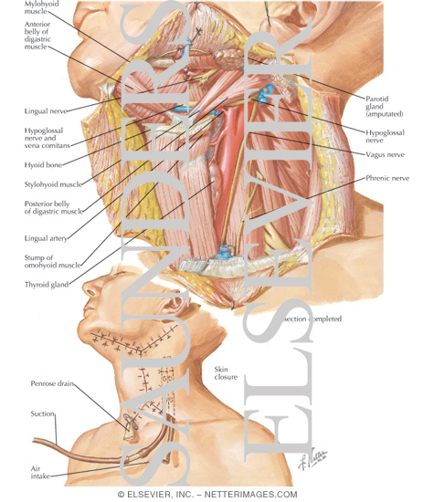 radical neck dissection