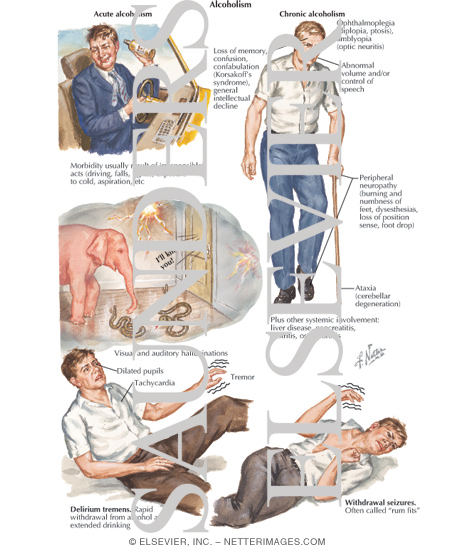 confabulation alcohol