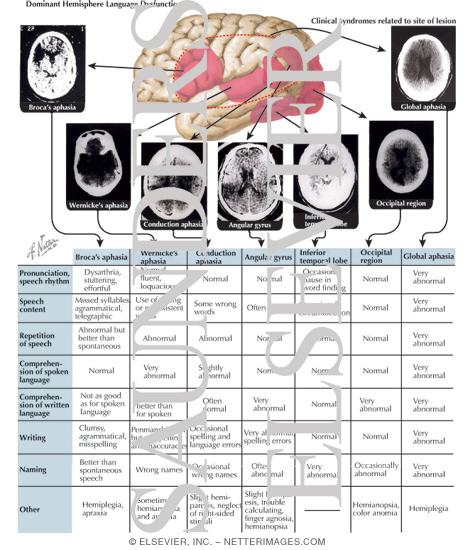Dominant Hemisphere Language Dysfunction