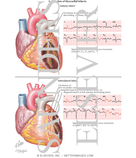 Localization Of Myocardial Infarcts