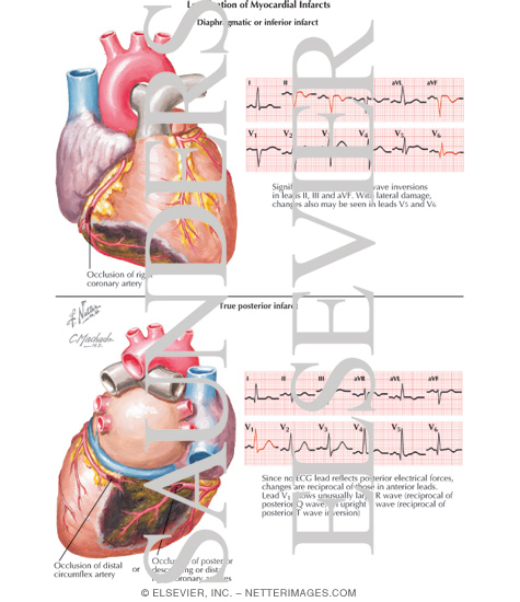 Localization of Myocardial Infarcts