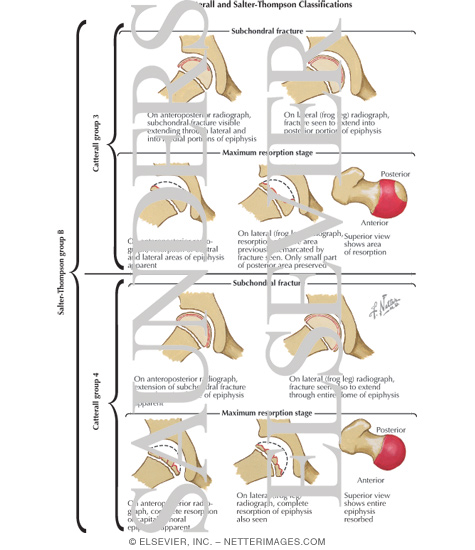 Catterall and Salter-Thompson Classifications