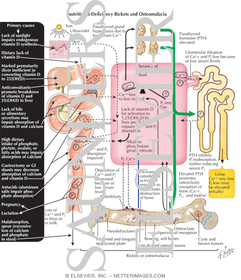 Nutritional Deficiency Rickets and Osteomalacia