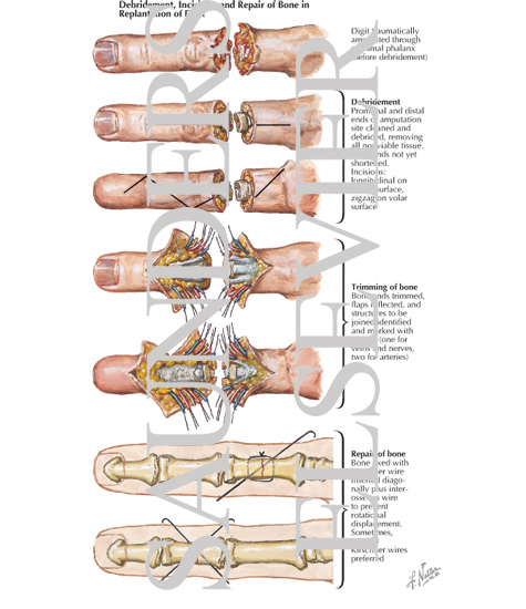 Debridement, Incisions, and Repair of Bone in Replantation of Digit