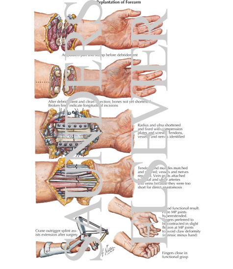 Replantation of Forearm