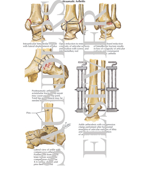 Posttraumatic Osteoarthritis
