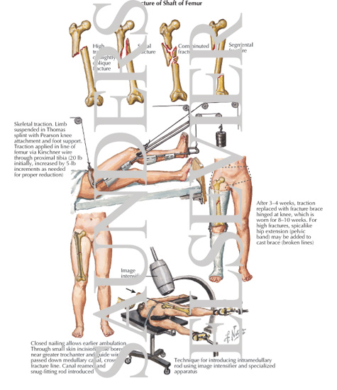 pearson attachment traction