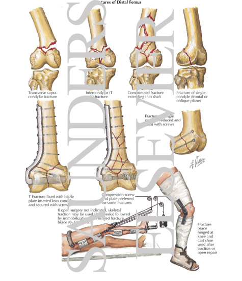 Fracture of Distal Femur