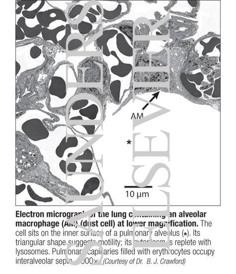 Electron Micrograph of the Lung Containing an Alveolar Macrophage (Dust ...