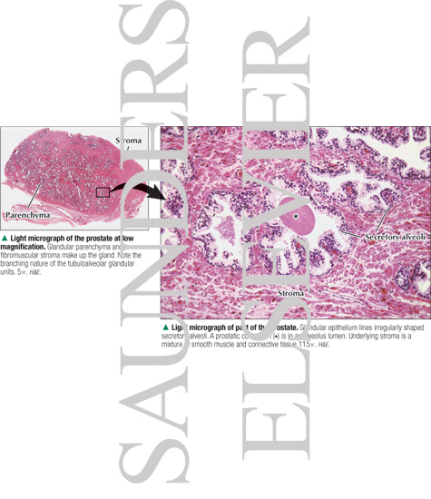 Light Micrograph of Part of the Prostate With Light Micrograph of the ...
