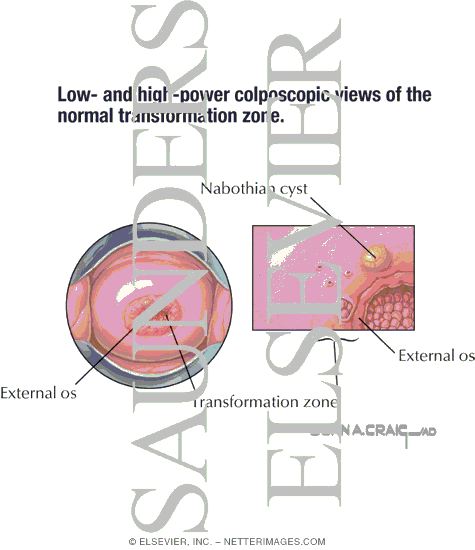 Low- and High-power Colposcopic Views of the Normal Transformation Zone