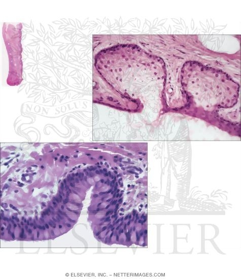 Light Micrograph Showing Two Alveoli of a Meibomian Sebaceous Gland ...
