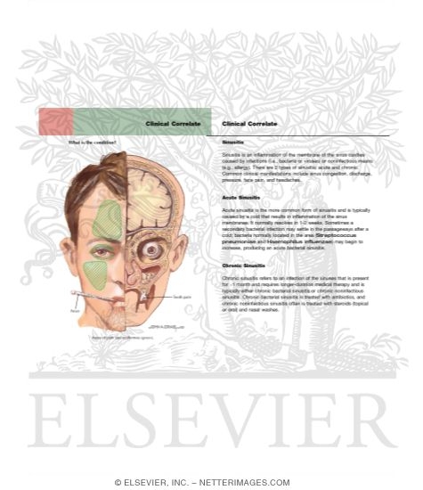 Sinusitis