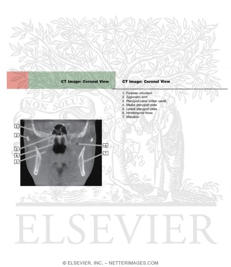 CT Image: Coronal View