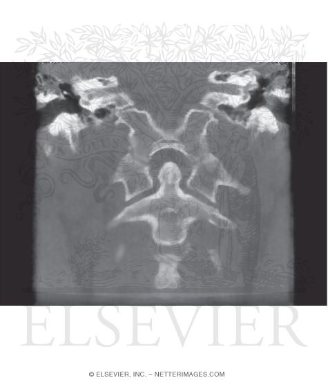 CT Image: Coronal View