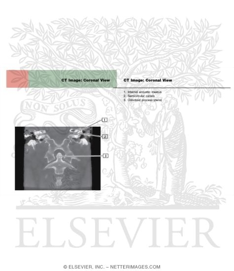 CT Image: Coronal View