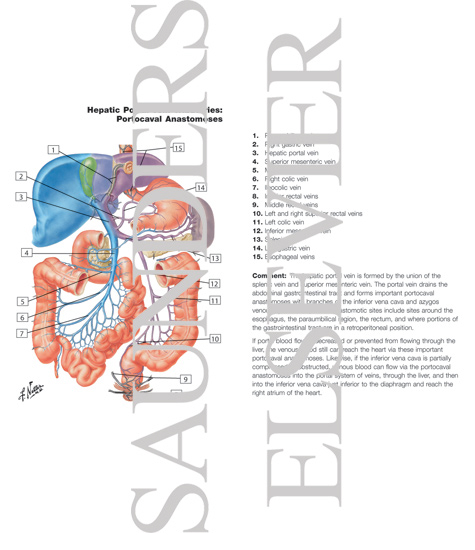 Portacaval Anastomosis Diagram